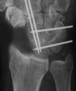 ARTHROSE Handgelenk – Zentrum für Handchirurgie Nürnberg