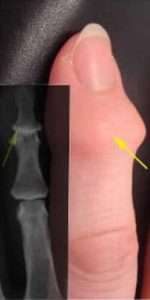 Arthrose – Gelenkverschleiß an den Fingergelenken – Zentrum für ...
