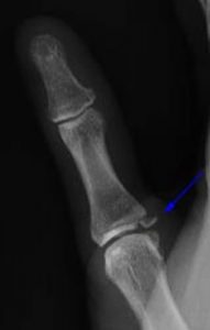 Ski-Daumen | Zentrum für Handchirurgie Nürnberg