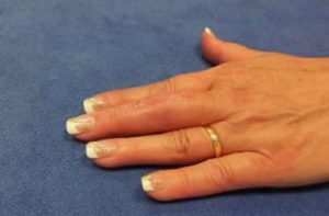 Strecksehnen-Risse | Zentrum für Handchirurgie Nürnberg