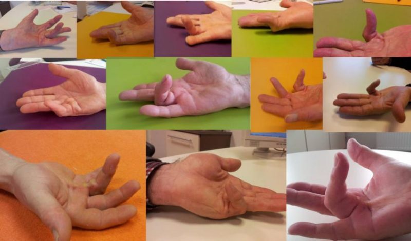 Morbus Dupuytren ( Dupuytren´ sche Kontraktur / Beugeversteifung der ...